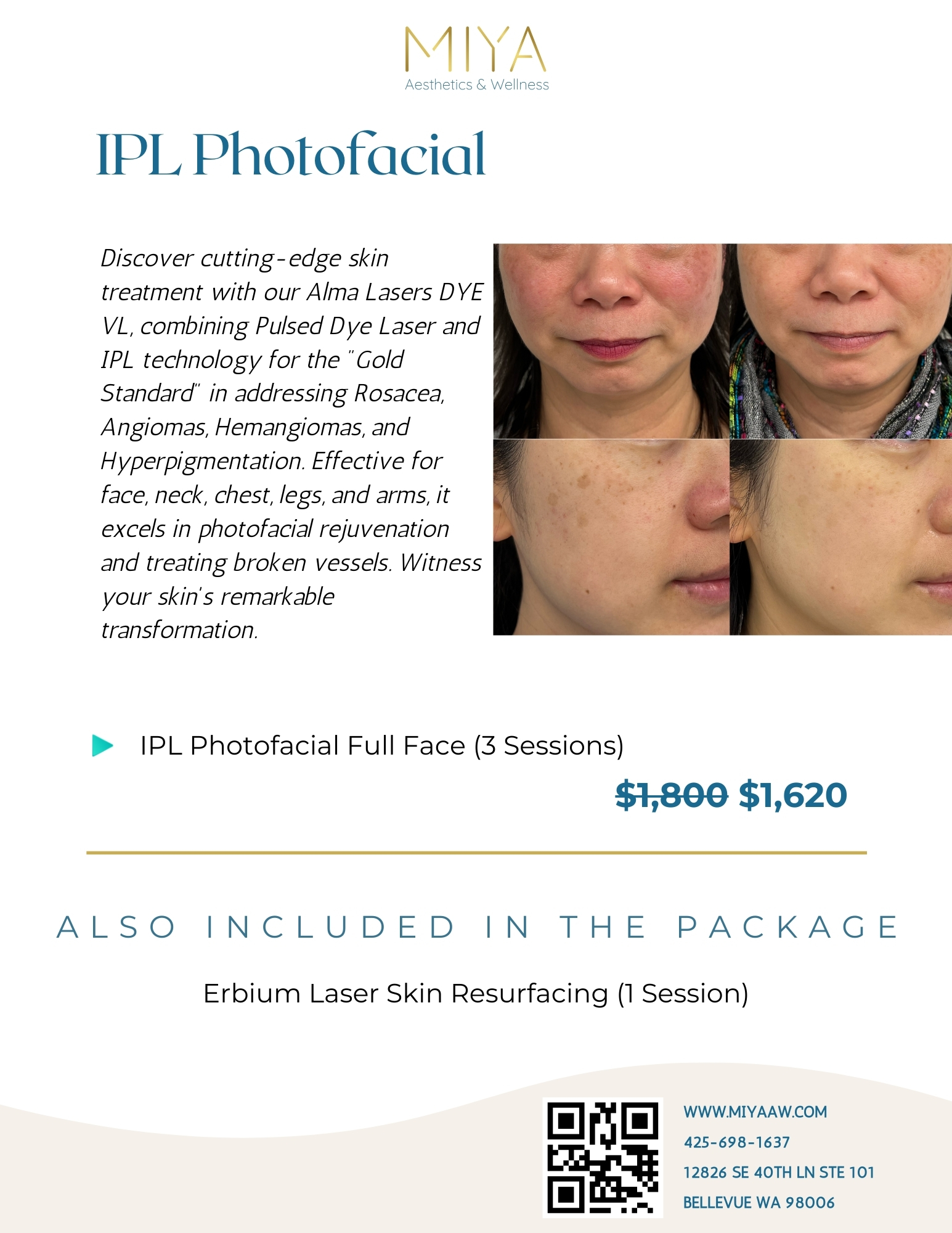 IPL Photofacial - MIYA Aesthetics & Wellness